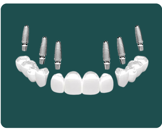 3 On 6 Dental Implant System - allondental.com