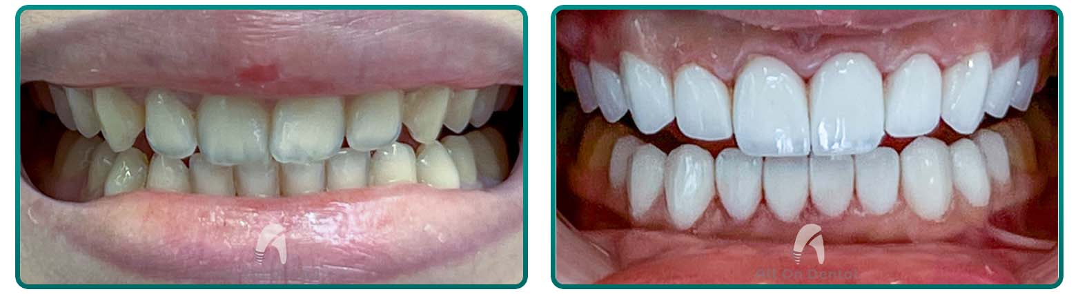 All You Need To Know About Dental Veneers In Turkey! - allondental.com