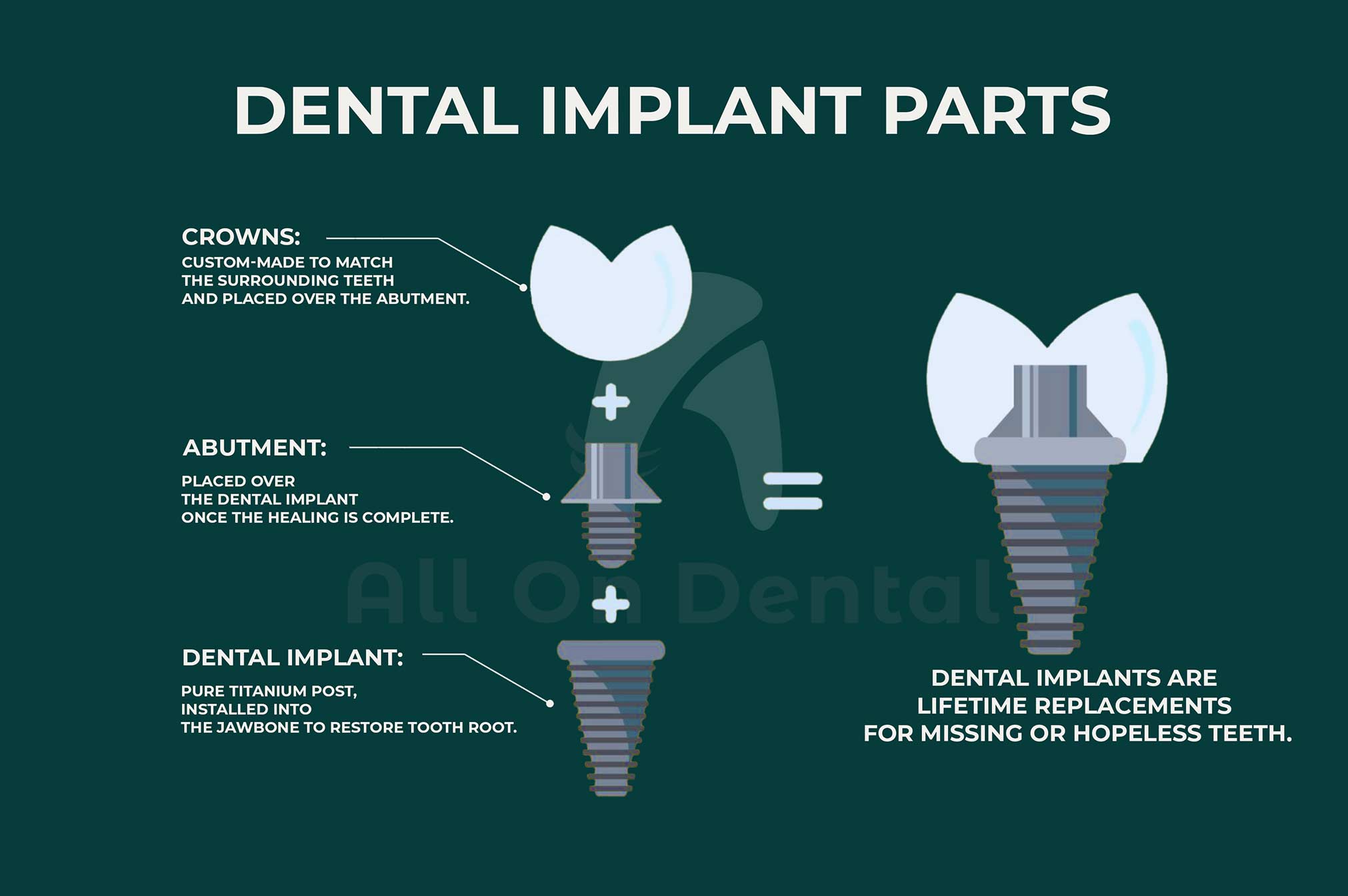 Dental Implant - allondental.com