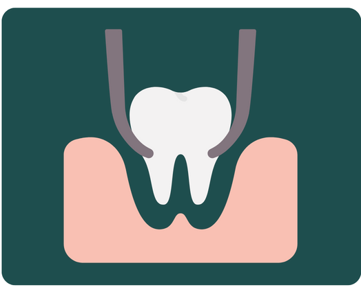 Surgical Tooth Extraction - allondental.com